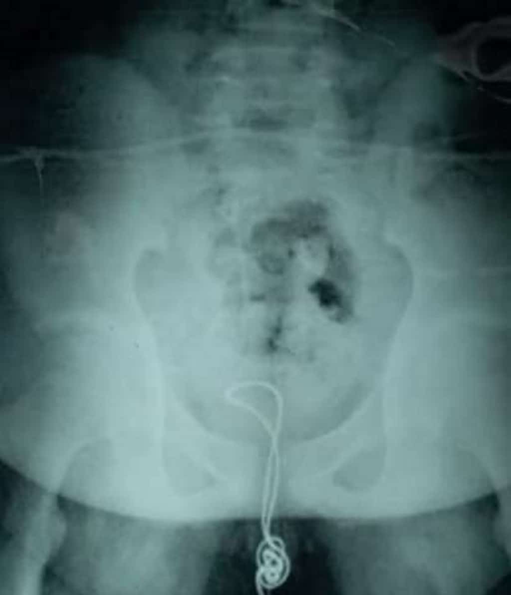 Este Adolescente Ten a Un Cable De USB Dentro Del Pene Quo
